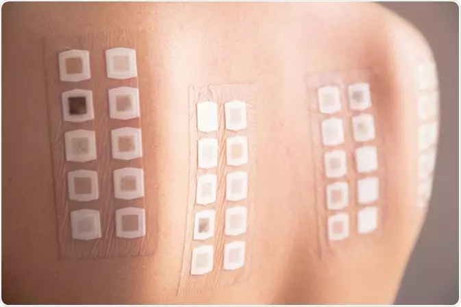 Allergy Patch Testing