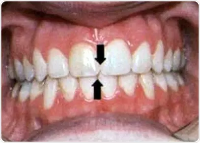 Malocclusion څه شی دی؟ 10188_1