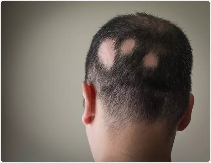 Kedu ihe bụ alopecia?