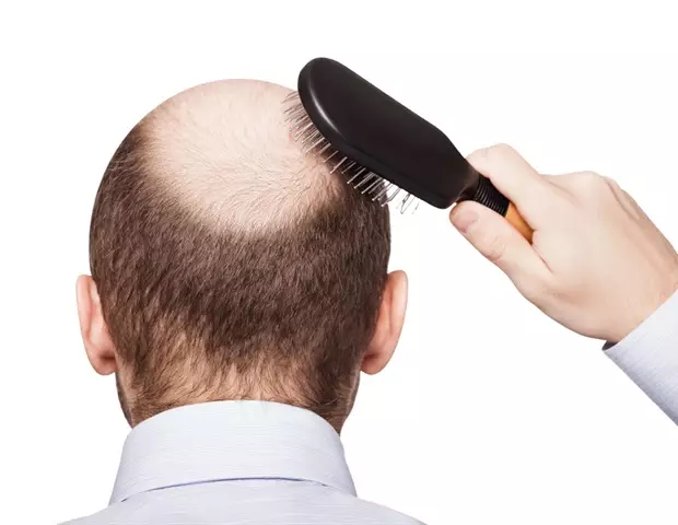 Ụdị ntutu na traction Alopecia