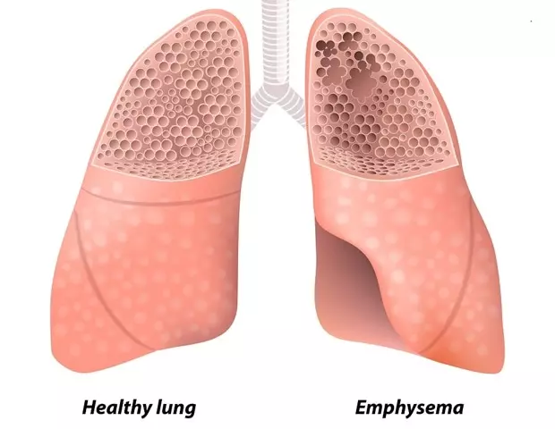 Was ist Alpha-1-Antitrypsin-Mangel?