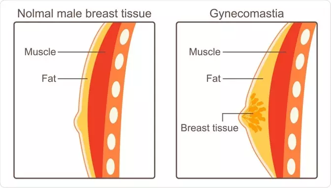 Diagram van ginekomastie - Deur CHEN I CHUN