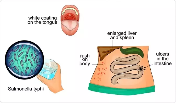 Síntomas de la fiebre tifoidea