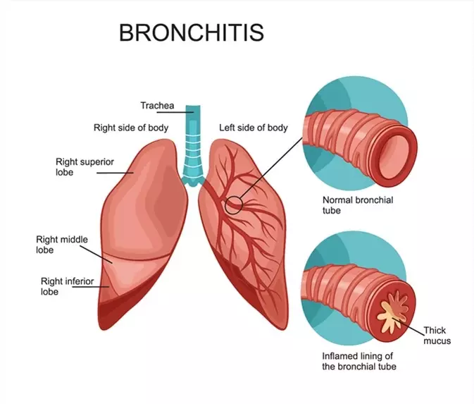 Bronhit. Surat krediti: logika600 / Shutterstock