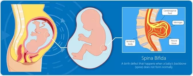 i-spina bifida