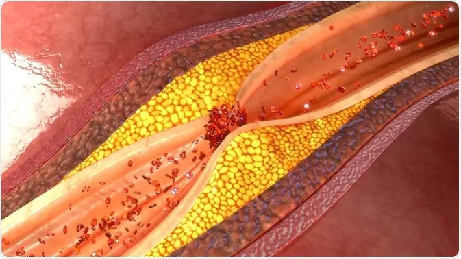 Stenosis ya Ateri ya Carotid ni nini? 1843_1