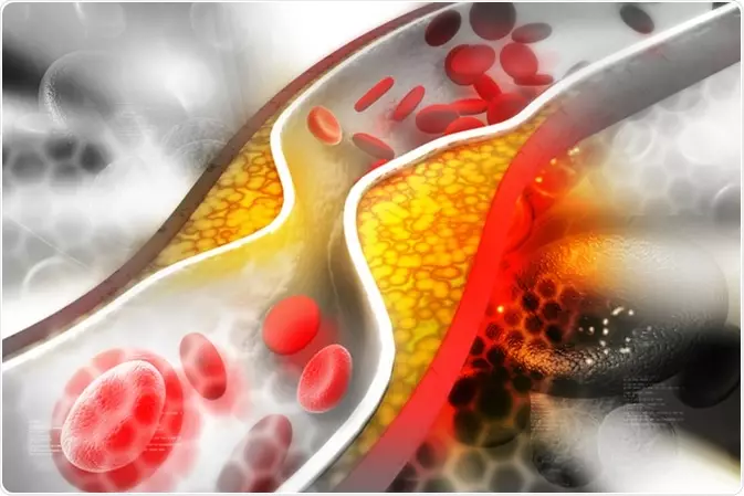 Cholesterol plaque mu mitsempha, fanizo. Ngongole yazithunzi: hywards / Shutterstock