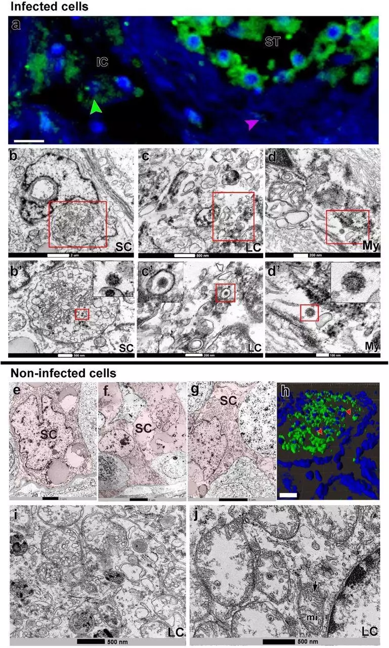 SARS-CoV-2 hutachiona muSertoli, Leydig uye peritubular myoid masero. a) Immunofluorescence inopesana neS-protein ichiratidza kusasimba kunyorwa mu peritubular myoid (pink arrowhead) uye Leydig masero (yegirinhi museve musoro) (Chiyero bar = 15µm). b-d') TEM mifananidzo inoratidza hutachiona hwehutachiona (mukudzika uye yakakwirira magnification) muSertoli cell (SC) (Scale bars = b: 2µm; b': 500nm); Leydig cell (LC) (Scale bars = c: 500nm; c': 200nm uye peritubular myoid cell (Yangu) (Scale bars = d: 200nm; d': 100nm). e-g) TEM mifananidzo yeSertoli masero asina utachiona (SC) , pink) (Sikero mbariro = e: 2µm f-g: 5µ). h) 3D kuvakwazve kwe seminiferous tubule muchinjiko-chikamu chinoratidza nzvimbo dzisina kunyorwa dzakatenderedza masero eutachiona (mitsvuku yemiseve) (Scale bar = 40µm). i-j) kukwidziridzwa kwemasero eLeydig asina utachiona. Museve = tubular crest ye mitochondria (mi) (Chiyero mabara = 500nm). Immunofluorescence mifananidzo mune testis yemurwere #8. TEM mifananidzo mumatestu kubva kuvarwere #1, #7 uye #8.