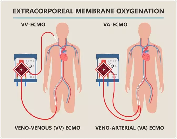 Hoe word ECMO gebruik om ernstige COVID-19 te behandel?