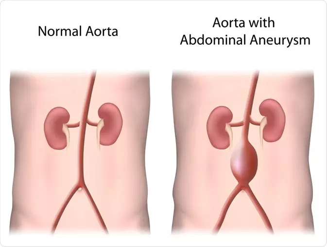 Normal abdominal aorta maringe neAAA