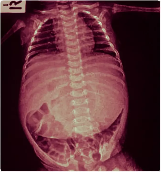 Radiographie du corps du nourrisson et distension abdominale (flatulences, maux d'estomac, douleurs). Crédit d'image : Tewan Banditrukkanka/Shutterstock