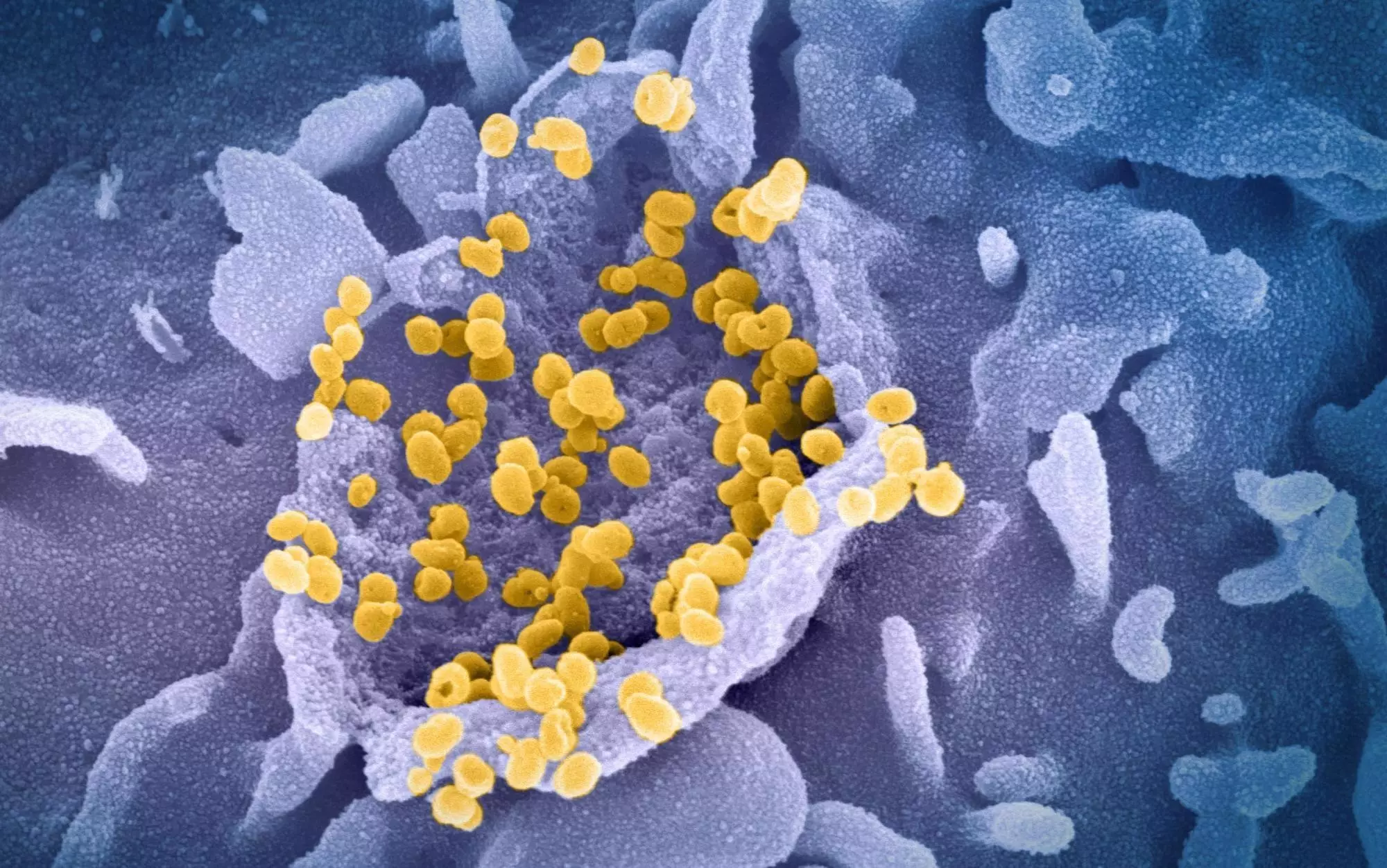 Uphononongo: i-Notch1-CD22-Dependent Immune Dysregulation kwi-SARS-CoV2-Associated Multisystem Inflammatory Syndrome ebantwaneni. Ikhredithi yoMfanekiso: NIAID