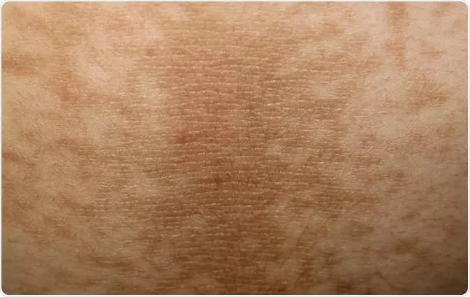 Состојба на кожата на Acanthosis Nigricans