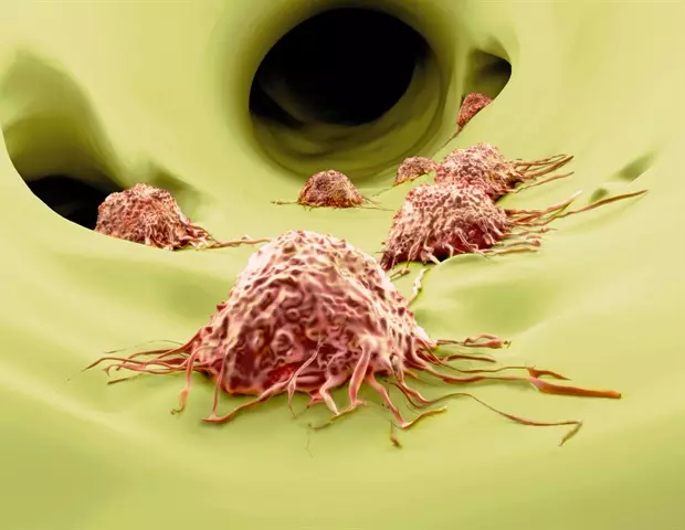 HMGA1 svolge un ruolo nella proliferazione e metastasi delle cellule del cancro gastrico