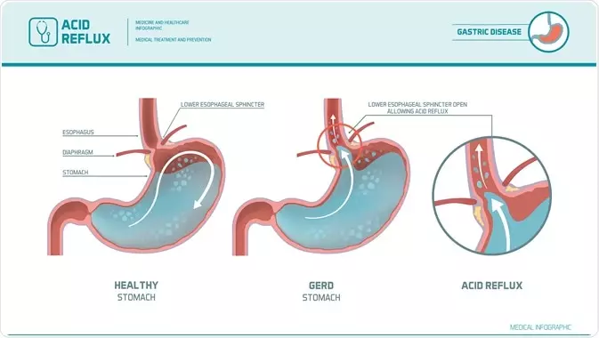 Causes de l'acidesa (reflux àcid)