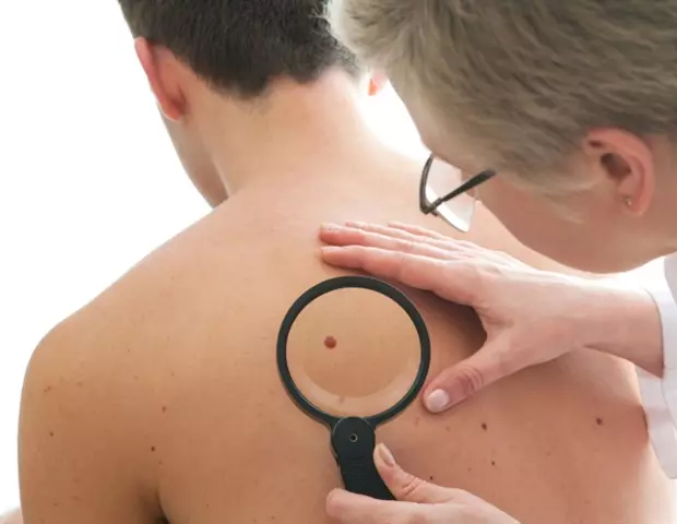 MITF belogy melanoma üçin täsirli derman bejergisini ösdürmäge kömek edip biler