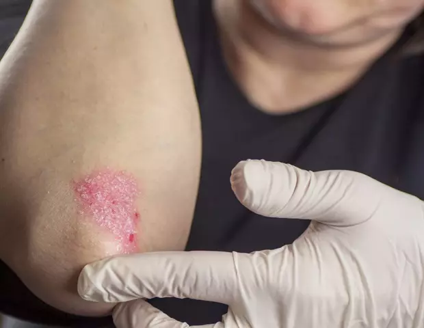 Iwadi ṣe awari pe awọn eniyan ti o ni psoriasis ko ṣeeṣe lati fesi si awọn iwo ti ikorira nipasẹ awọn miiran