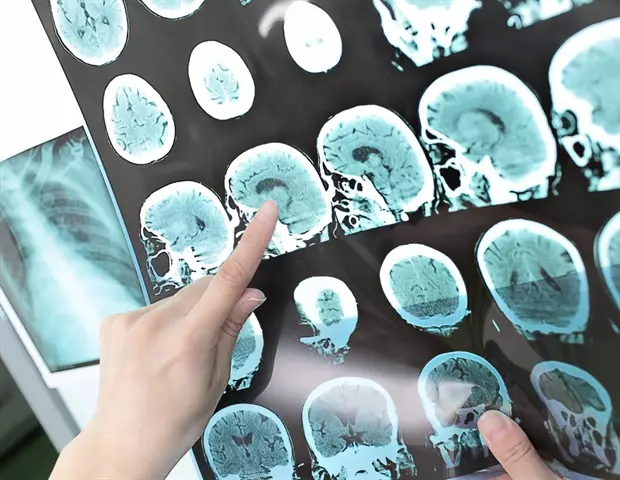 Ratusan stroke bisa dihindari, nyebutkeun ulikan