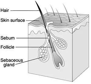 Causes de l'acne