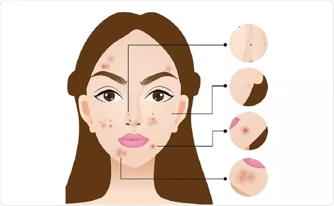 Tractaments de l'acne