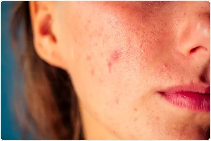 Acne em Mulheres