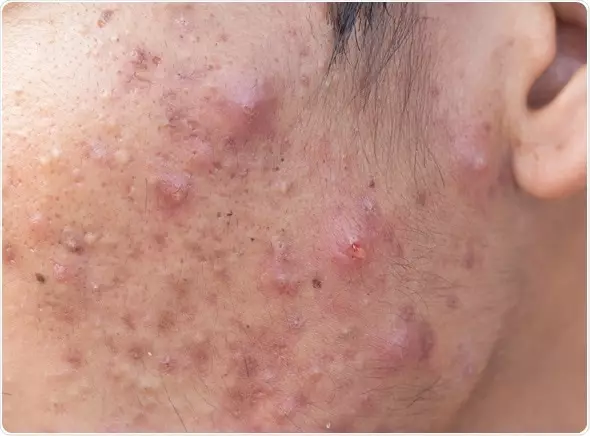 Adult Acne - Cututtukan fata