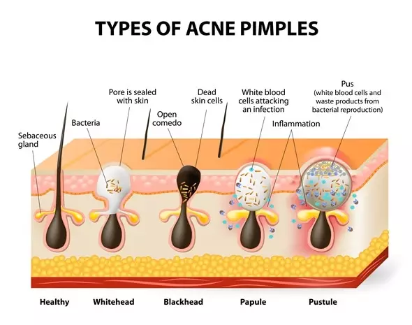 Papules, Pustules da Nodules