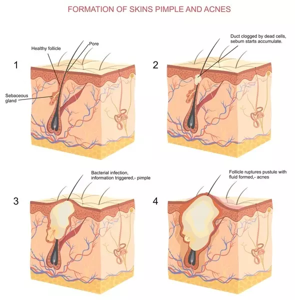 Blackheads da Whiteheads: Bayani