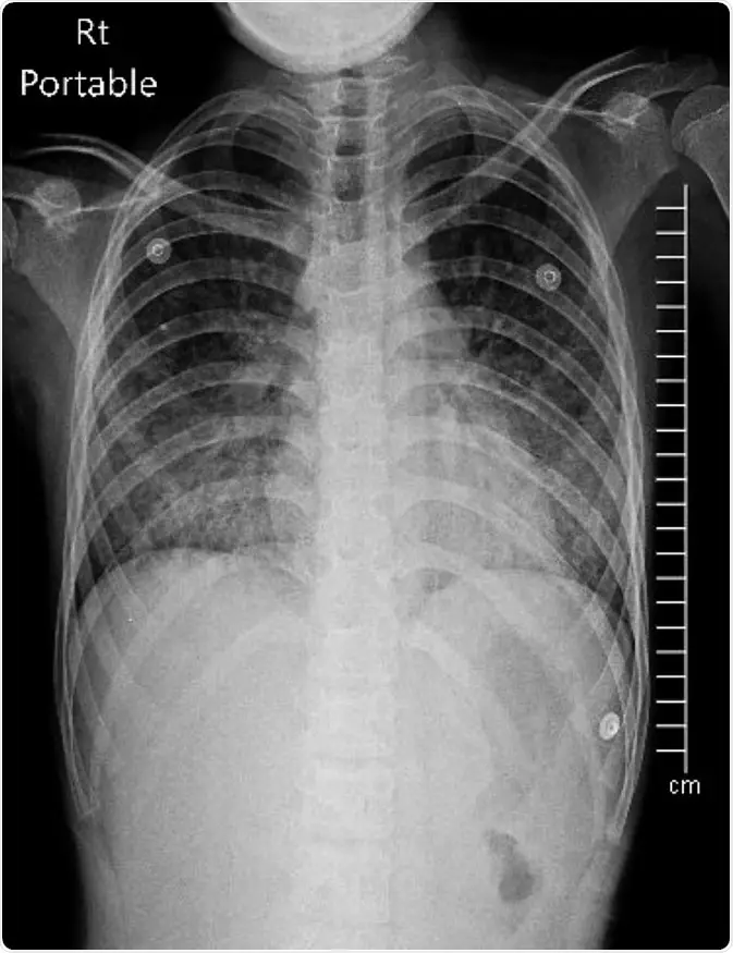 Cos'è la Sindrome da Distress Respiratorio Acuto (ARDS)?