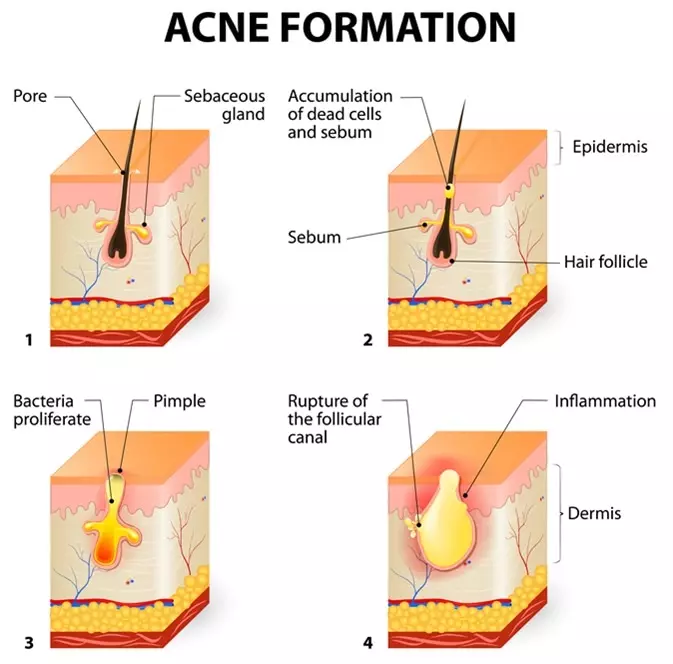 Kabentukna jarawat kulit atanapi jarawat. The sebum dina pori clogged promotes tumuwuhna baktéri tangtu (Propionibacterium Acnes). Ieu ngakibatkeun redness and inflammation pakait sareng pimples. Kredit Gambar: Designua / Shutterstock