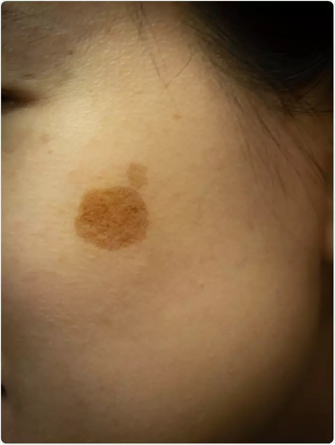 Gorpigmentation ac Acne