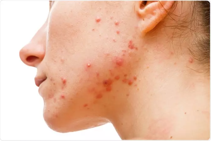 Balat ng acne. Credit ng Larawan: Ocskay Bence / Shutterstock