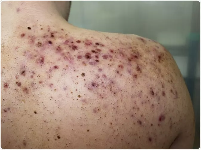 Gənc kişidə acne vulgarisin (acne conglobata) ağır forması halı. Şəkil krediti: Dermatology11 / Shutterstock