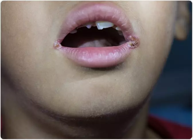 Actinic Cheilitis - लक्षण और कारण