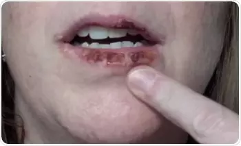 Prognosis Cheilitis Actinic û Penceşêra Devê