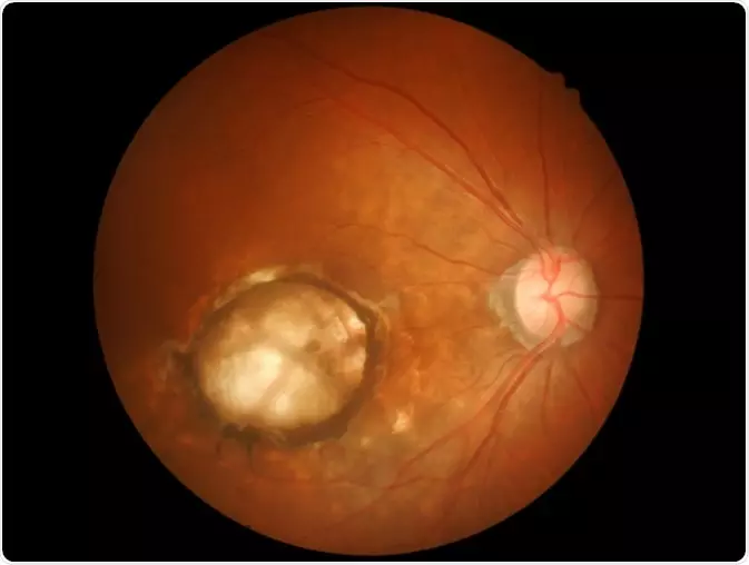 Macular Degneration