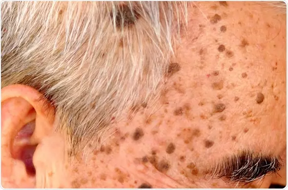 Pêşîlêgirtina Keratosis Actinic