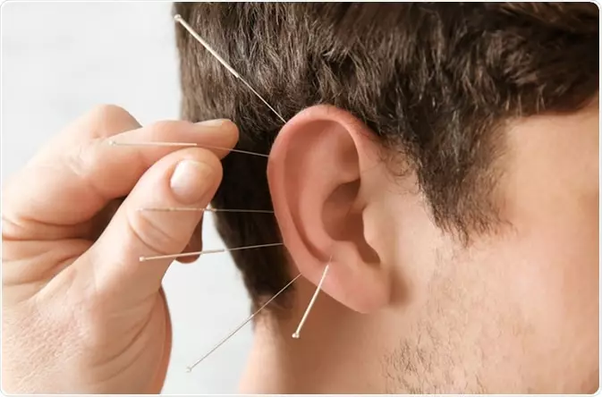 O le a le aoga o le Acupuncture?