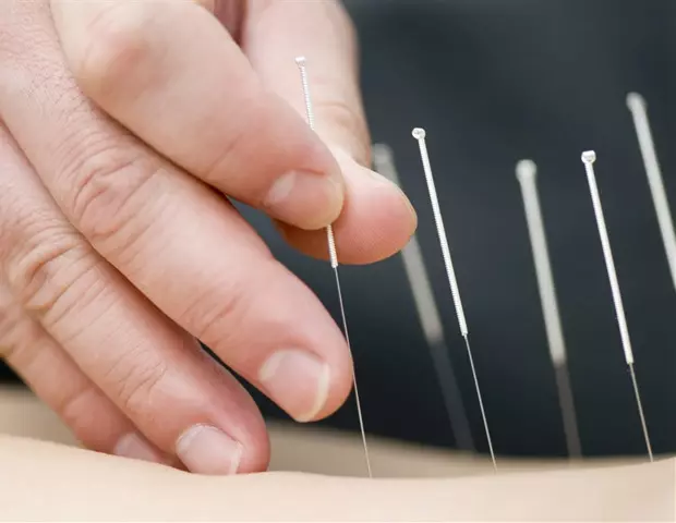 Legal na Katayuan ng Acupuncture