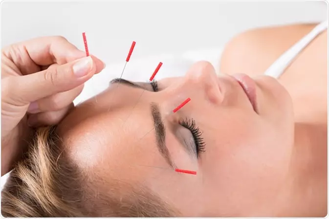 E Saogalemu le Acupuncture?