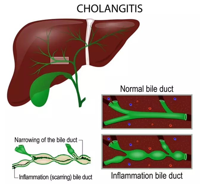 Unsa ang Acute Cholangitis?