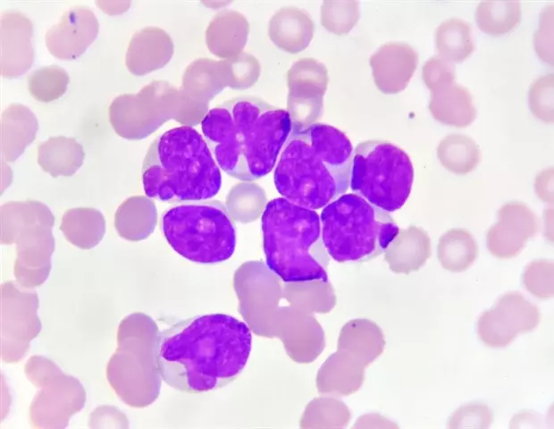 การบำบัดหลังการให้อภัย Acute Myeloid Leukemia (AML)