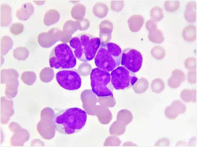 ਤੀਬਰ myeloid leukemia