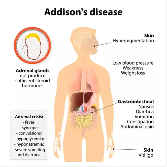 Ano ang Addison's Disease?