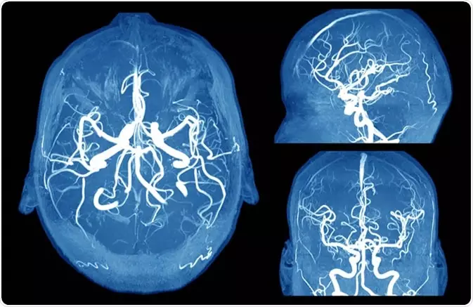 Garuneko aneurisma MRI. Irudi-kreditua: MriMan / Shutterstock