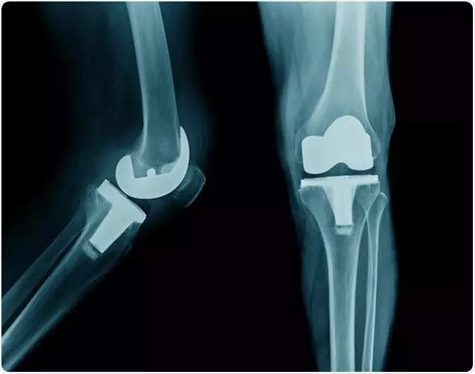 Picha ya X-ray jumla ya arthroplasty ya goti. Picha kwa hisani ya Tridsanu Thopet / Shutterstock