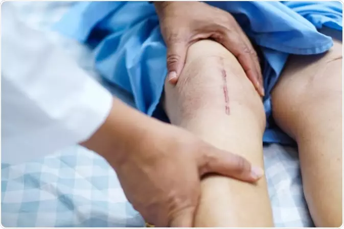 Makovu ya mgonjwa kutoka kwa arthroplasty ya pamoja ya goti. Mkopo wa Picha: Sasirin Pamai / Shutterstock