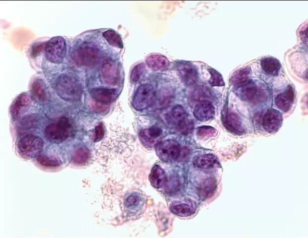 Histopatologi Adenokarsinoma