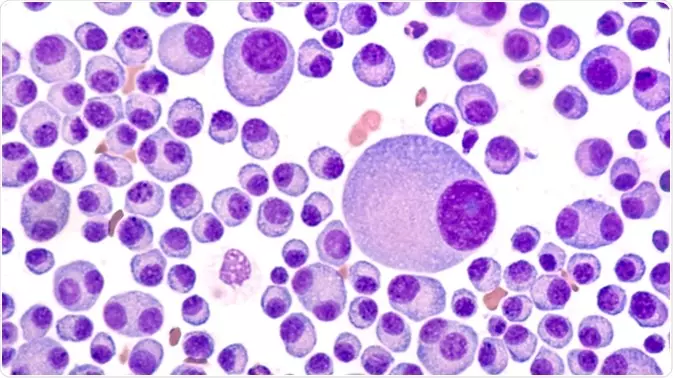 Ponaivi aspirate cytology o le tele o myeloma, o se ituaiga o le kanesa o le ga'o o ponaivi o sela plasma leaga, e fesootai ma tiga o ponaivi, gau ponaivi ma le anemia. Ata Fa'amatalaga: David Litman / Shutterstock