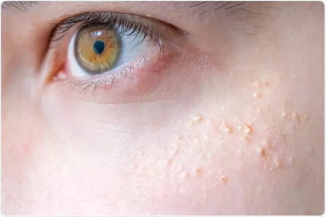 Milia (Milium) - pimples timpeall súl ar chraiceann. Creidmheas Íomhá: vchal / Shutterstock